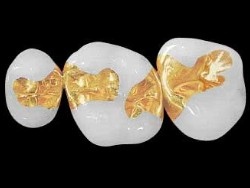 Drs. Brian & Mary Wicenski General Dentistry | Gold Inlays and Onlays ...